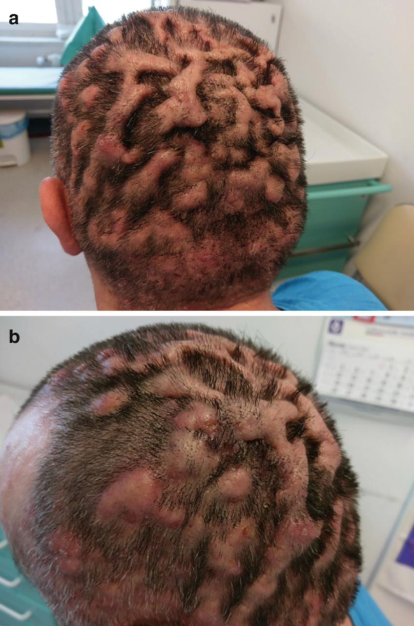 ## Oporna zapalenie cellulitis rozdzielające skóry owłosionej głowy ...